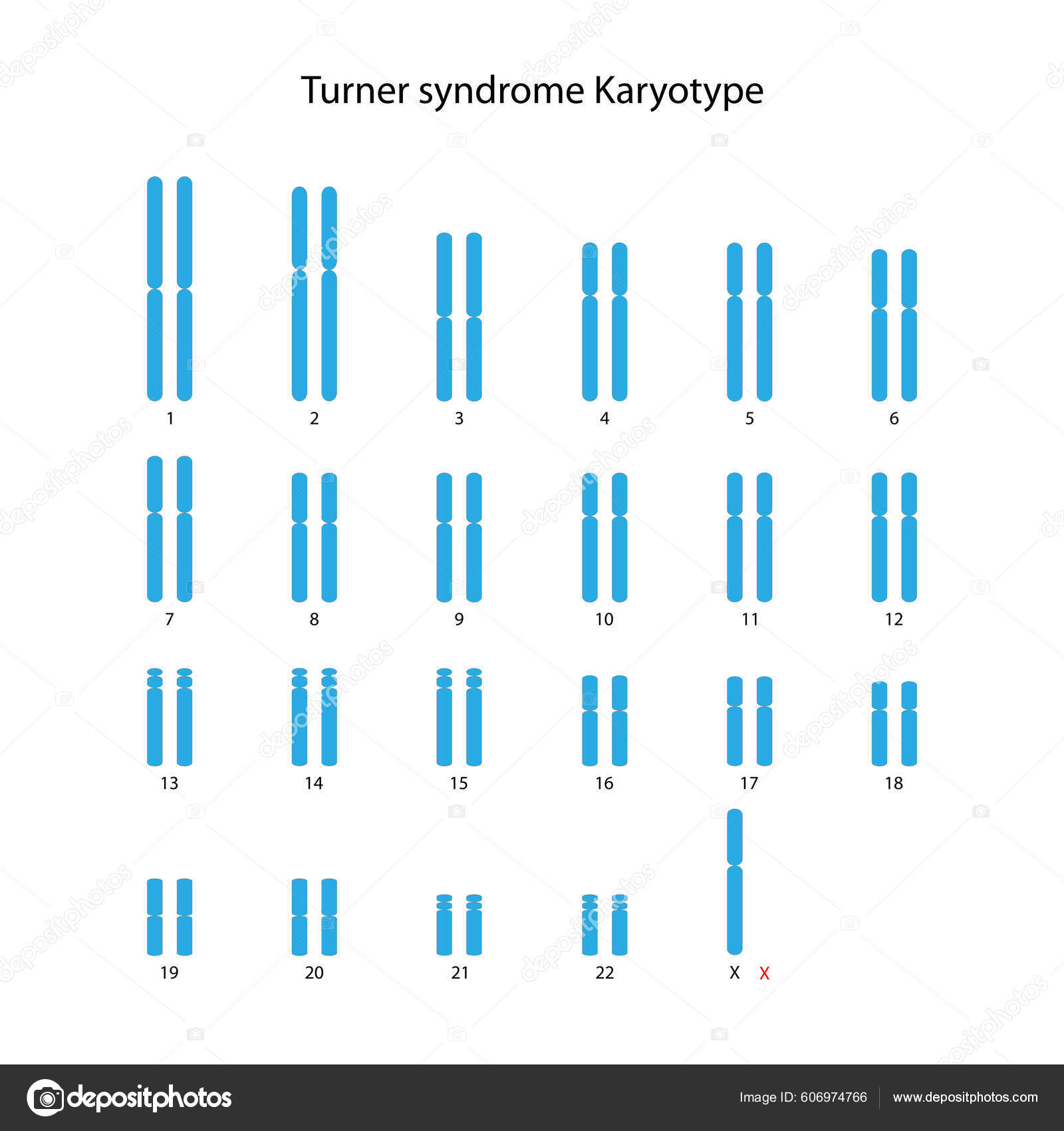 Turner Syndrome Human Karyotype Stock Vector by ©AStepBioMed 606974766