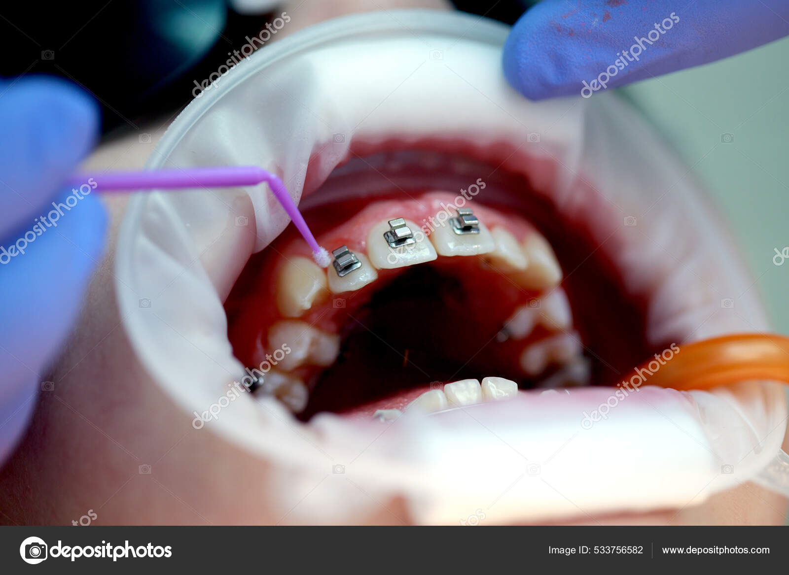 Installation Braces Upper Teeth Treatment Orthodontist Focus Braces ...