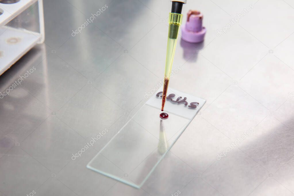 Preparación De Frotis De Médula ósea En El Laboratorio Preparación De