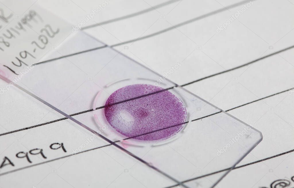 Diapositiva del microscopio citológico a base de líquido para la prueba ...