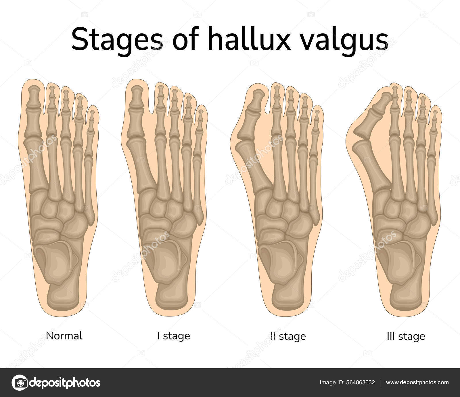 Three Stages Valgus Deformity Big Toe Stock Vector Image by ©scio21.ukr ...
