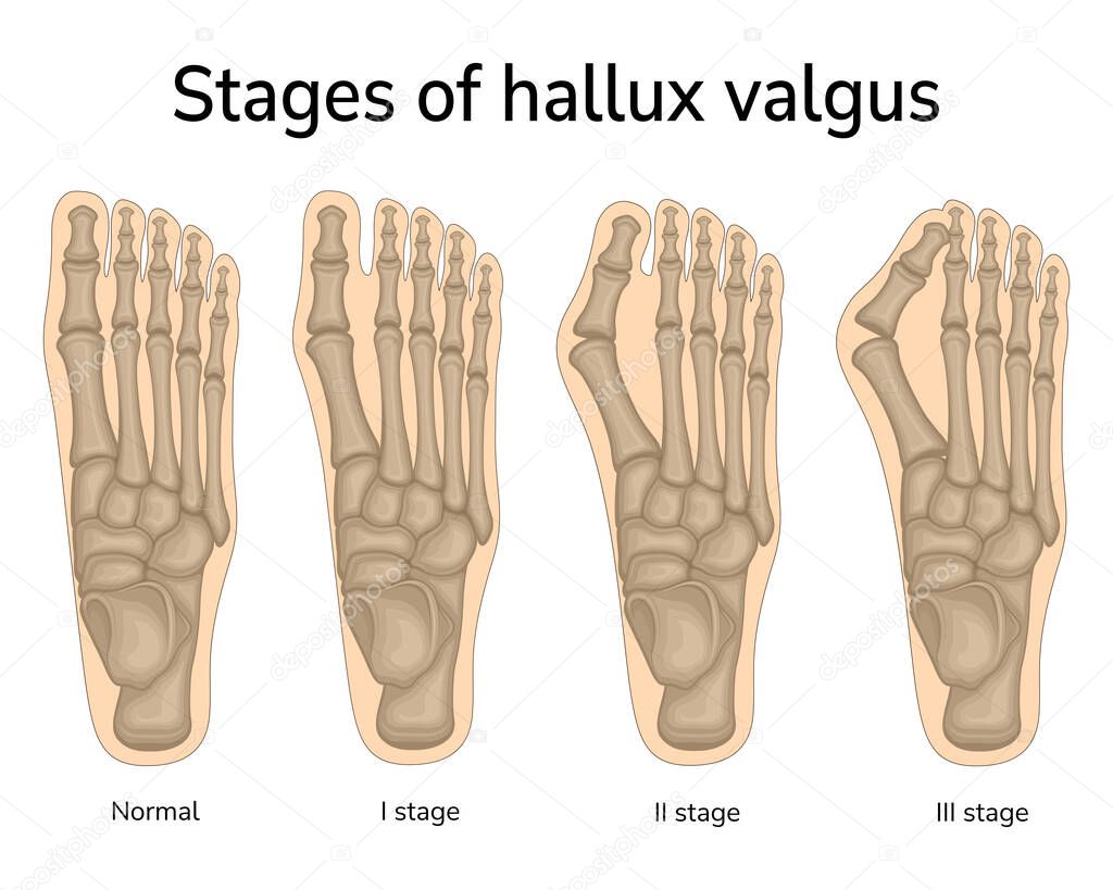 Three stages of valgus deformity of the big toe 2023