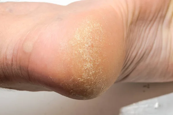 Psoriasis on the feet Stock Photos, Royalty Free Psoriasis on the feet ...