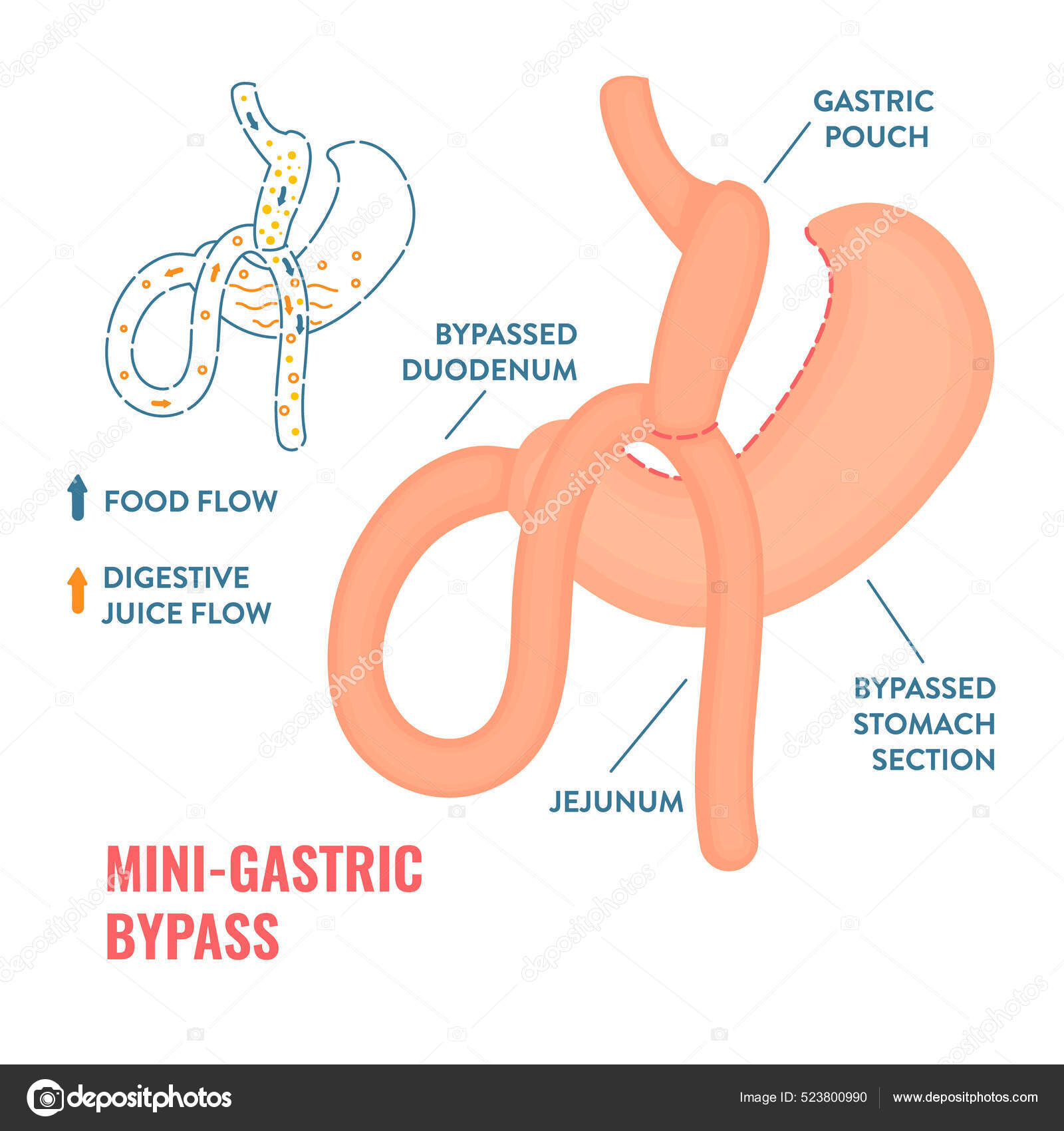 Mini gastric bypass bariatric surgery weight loss infographics Stock Vector by ©Naumas 523800990