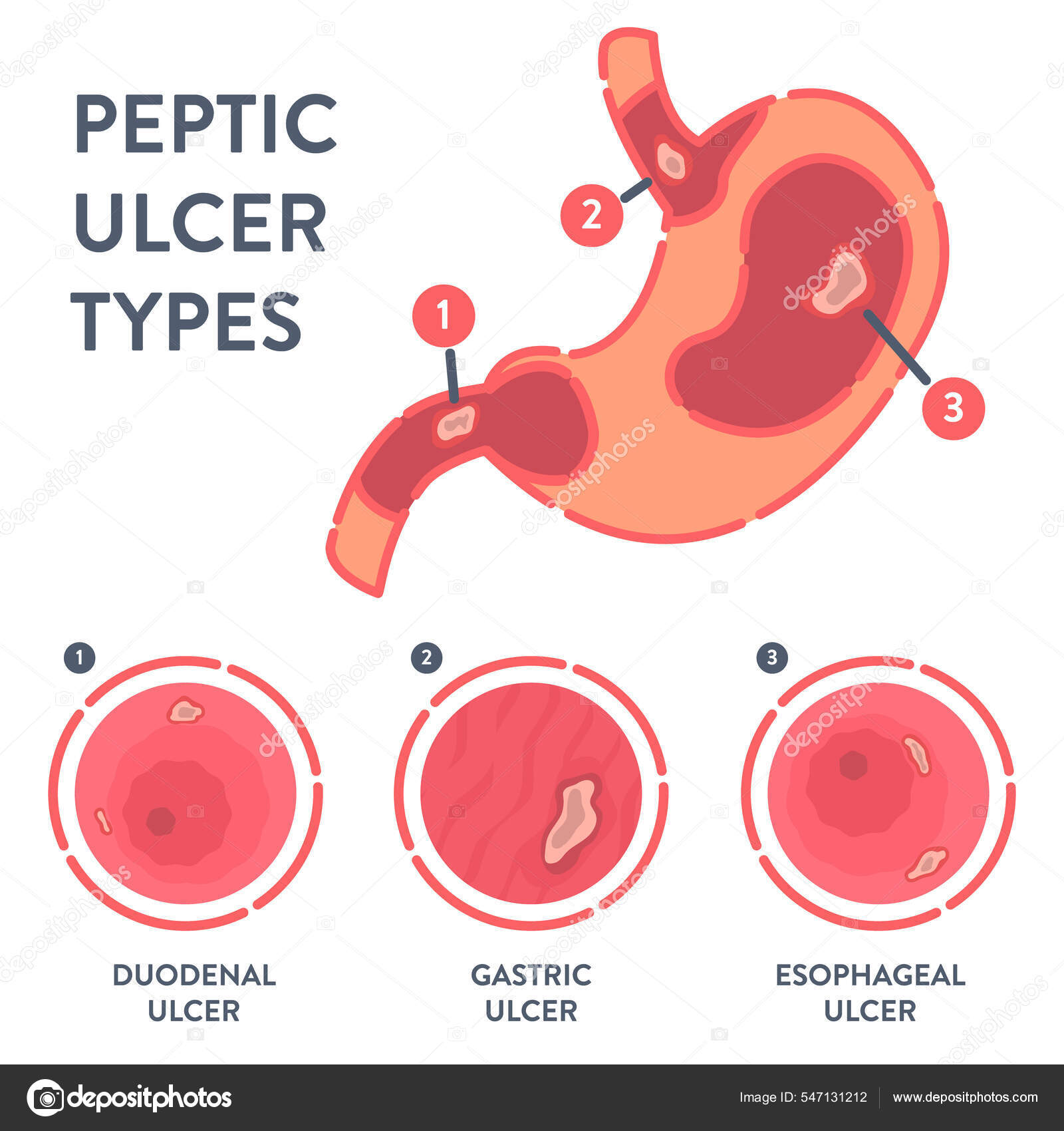 Tipos de úlcera péptica Infografías de enfermedades estomacales vector ...