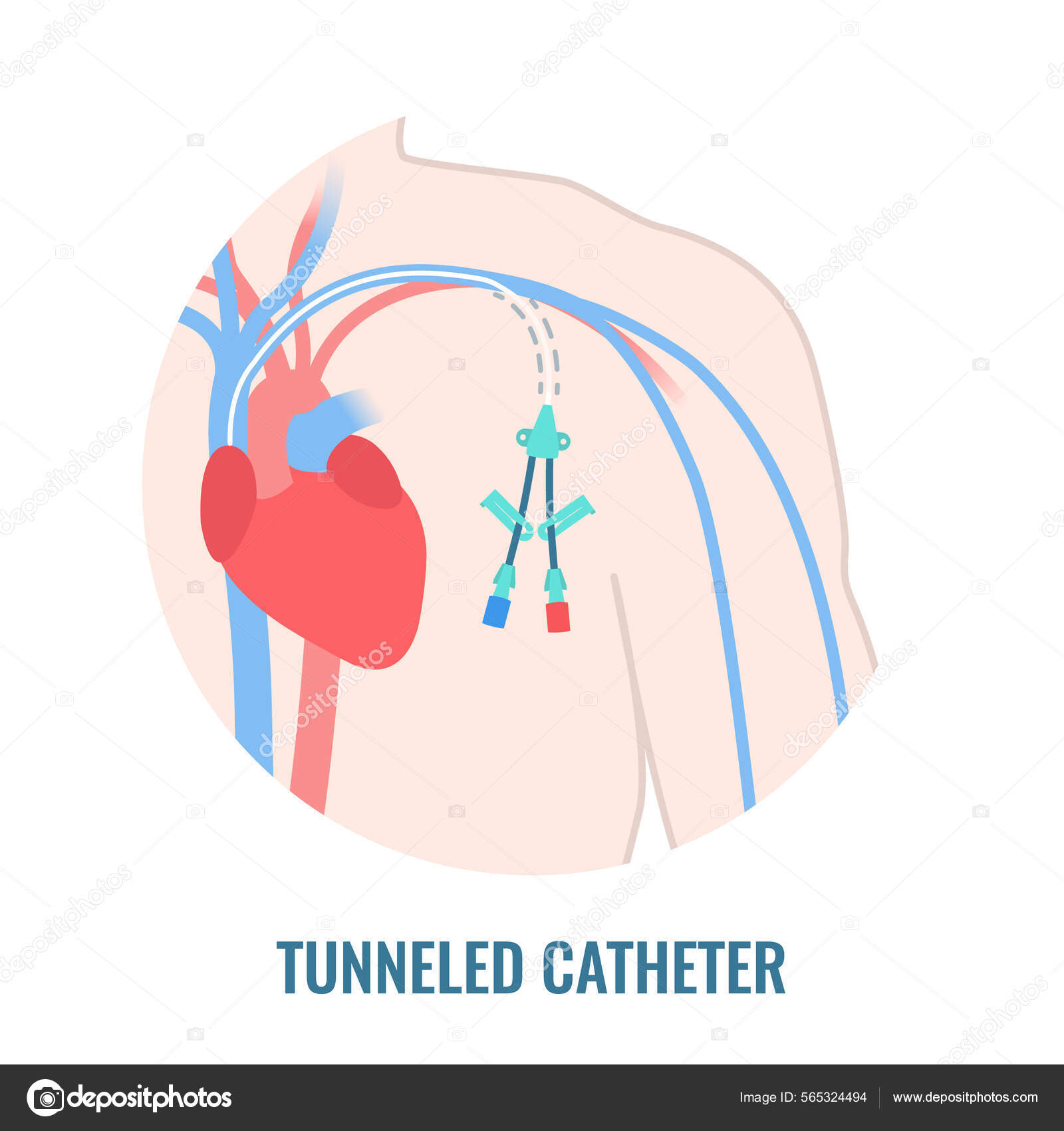 Tunnelvormige centrale lijn veneuze katheter close-up vectorafbeelding ...