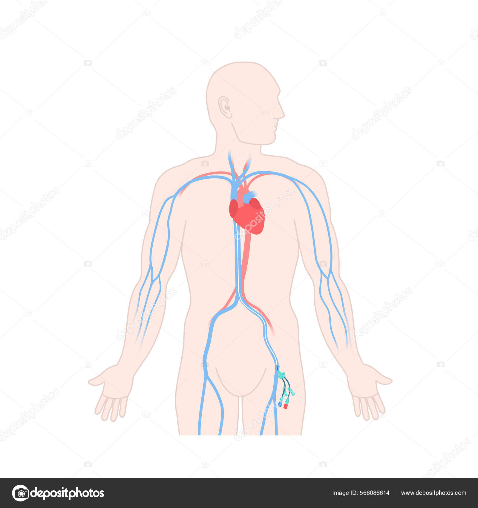Catéter venoso de línea central femoral en el cuerpo masculino Vector de stock por ©Naumas 566086614