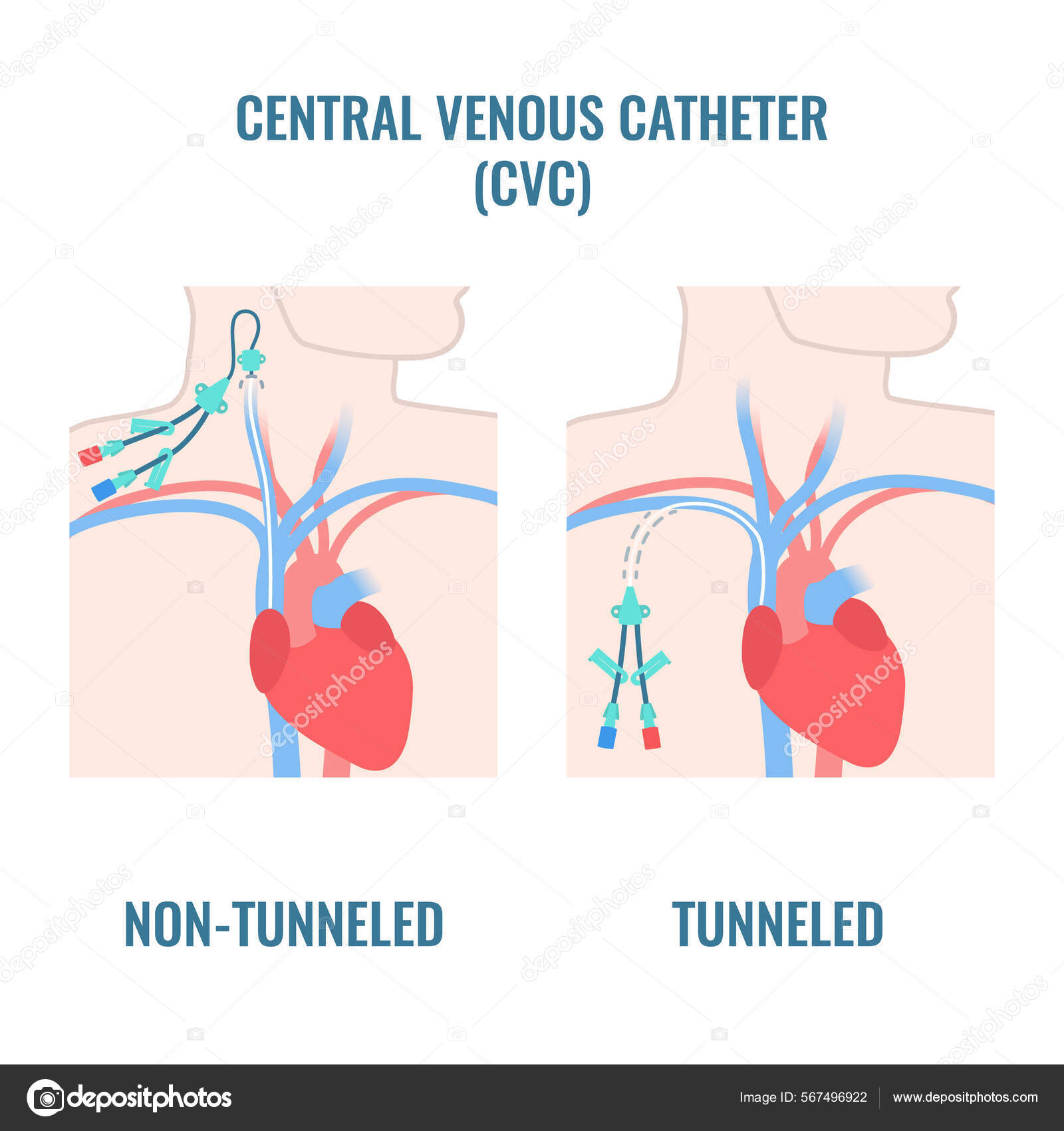 Central line venous catheter types on male body Stock Vector Image by ...