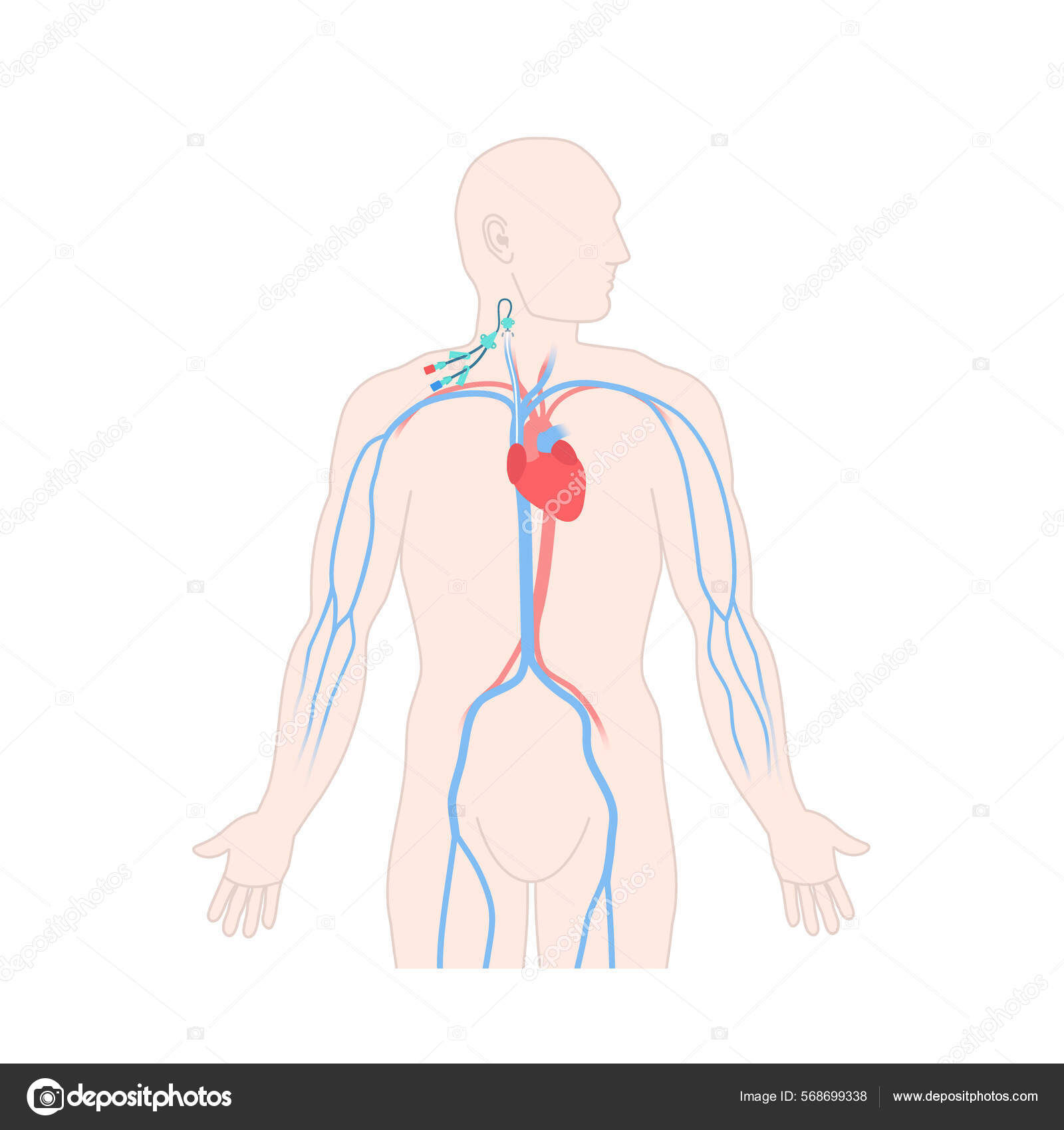 Central venous catheter in the jugular vein Stock Vector by ©Naumas ...