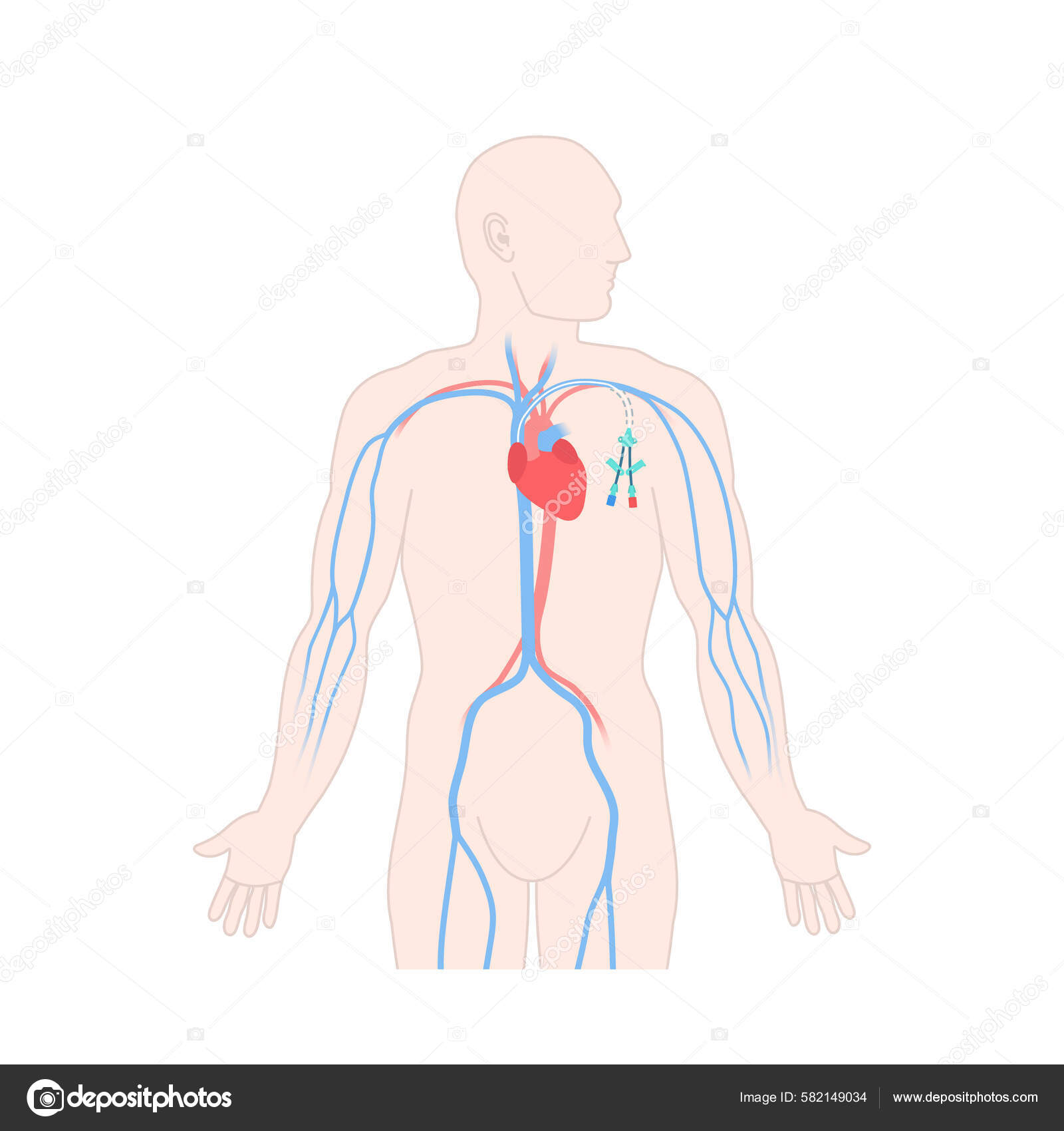 Tunneled Central Venous Catheter Placed Subclavian Vein Man Cvc Long ...