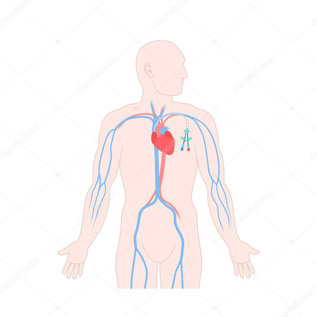 Catéter venoso central tunelizado colocado en la vena subclavia. Hombre ...