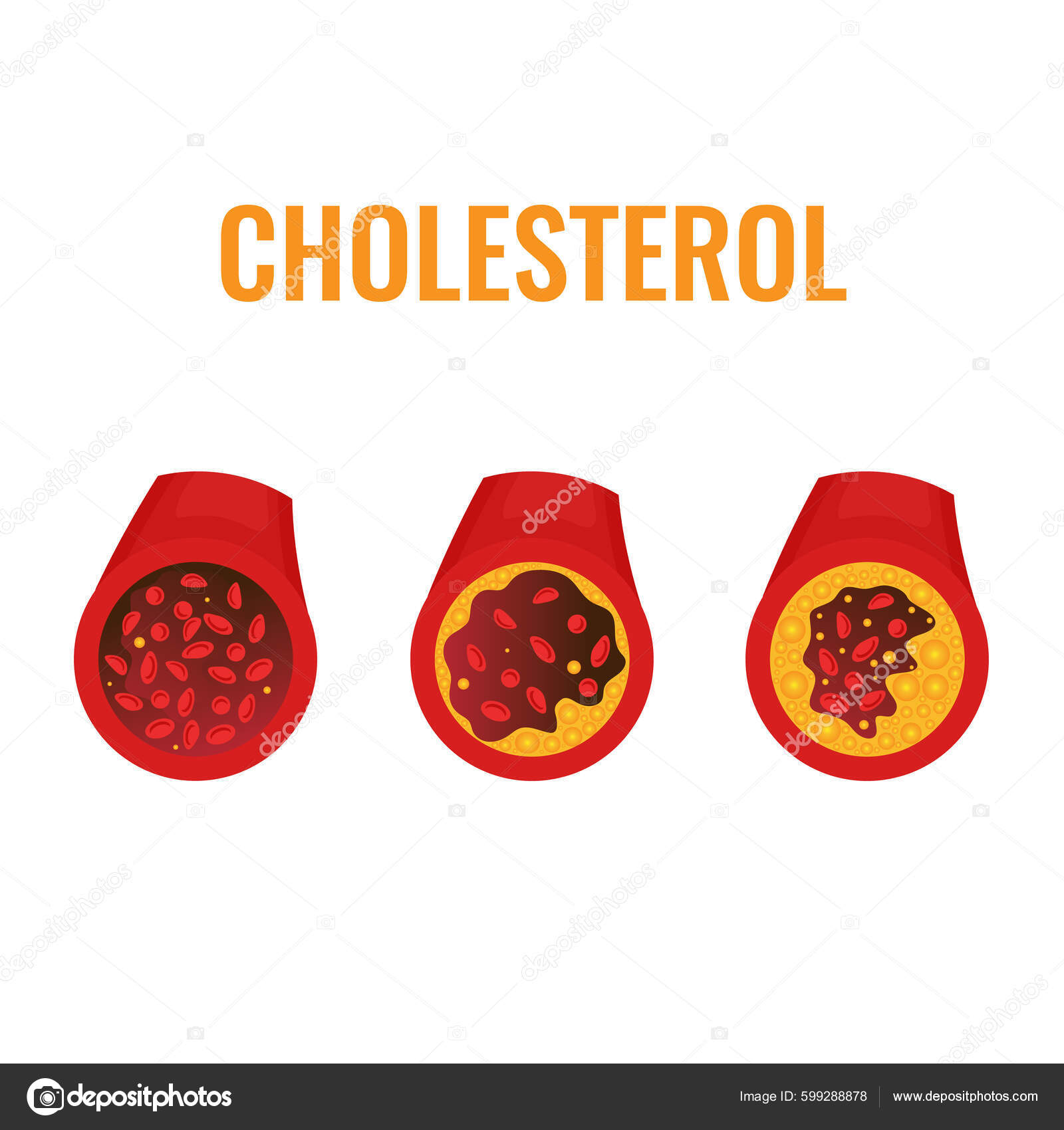 Cholesterol Plaque Blocked Blood Vessel Medical Diagram Ldl Hdl ...