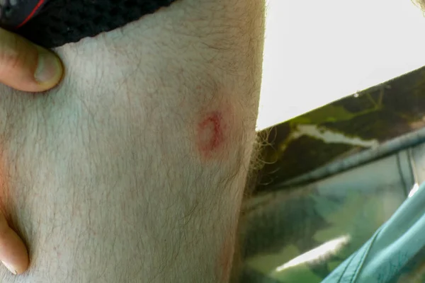 Paintball bruises Stock Photos, Royalty Free Paintball bruises Images ...