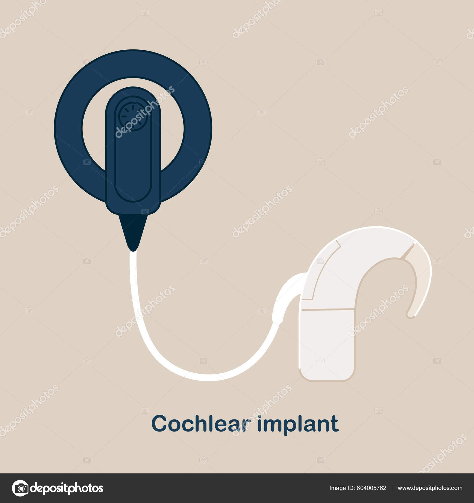 Cochlear Implant Vector Illustration Hearing Therapy Concept World Deaf ...