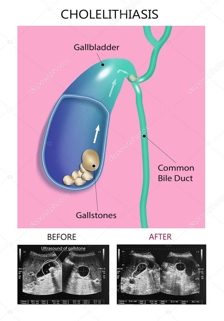 Ultrasonography image of gallbladder with gall stones at upper abdomen ...