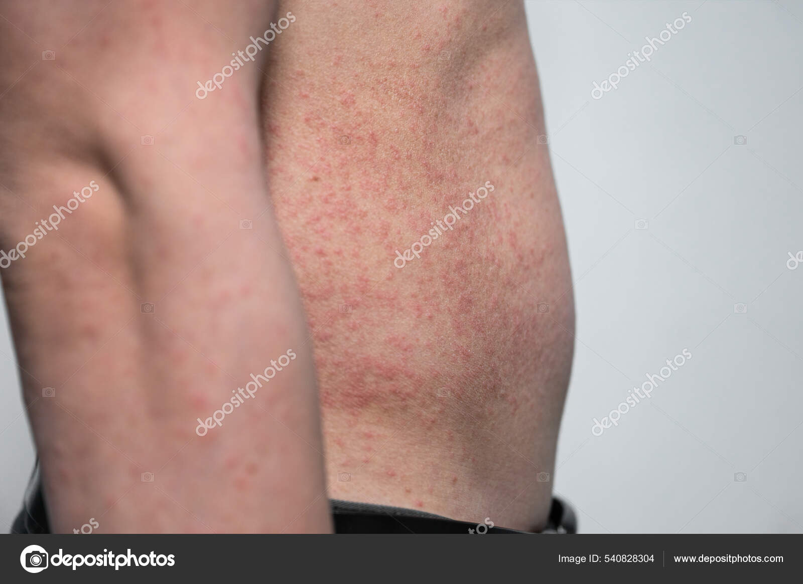 Dermatite Éruption Cutanée Maladie Virale Avec Immunodéficience Sur ...