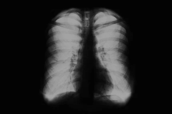 Radiograph of human chest Pictures, Radiograph of human chest Stock ...