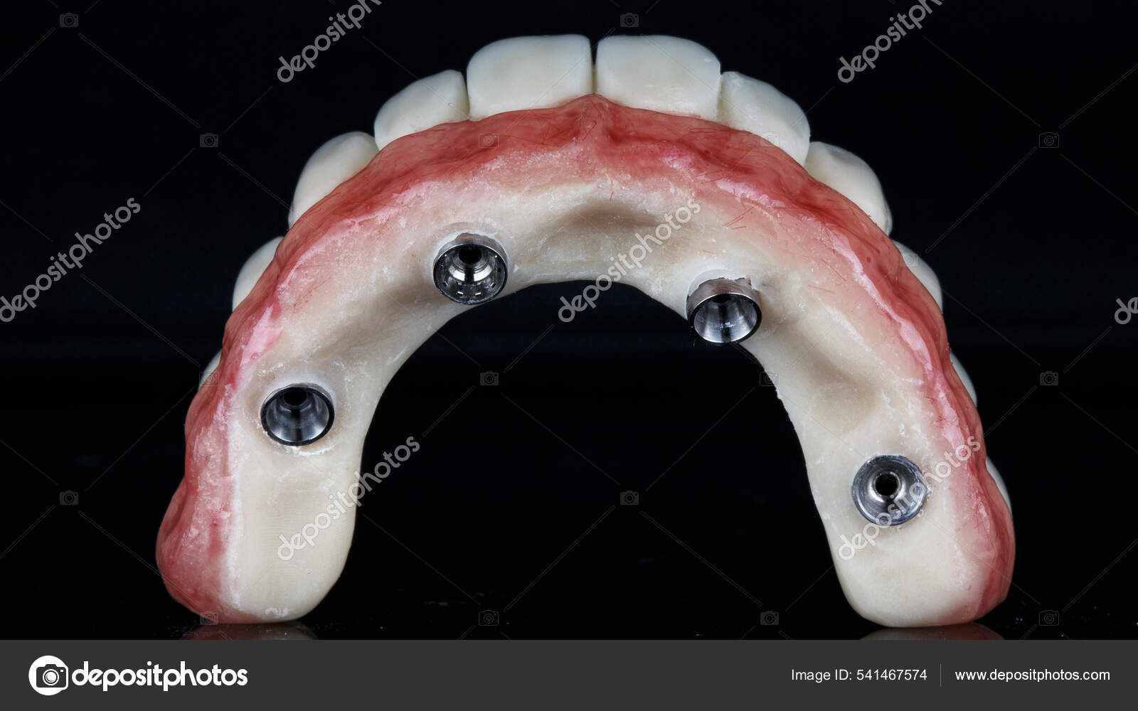 Artificial Gum Prosthesis Orthopedic Fixation View Shot Black ...