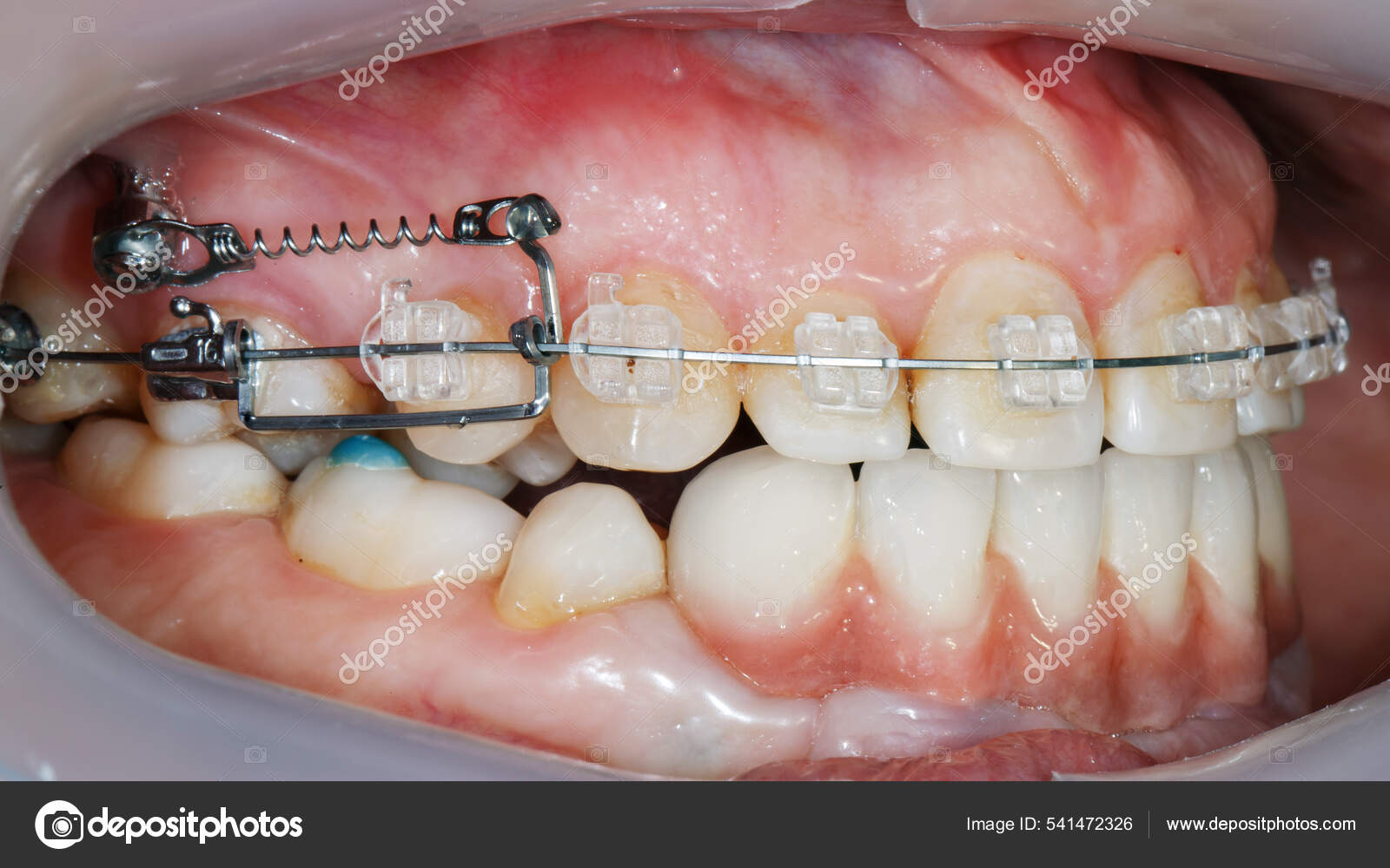 Brace System Smoothing Patients Bite Stock Photo by ©dendorstock 541472326