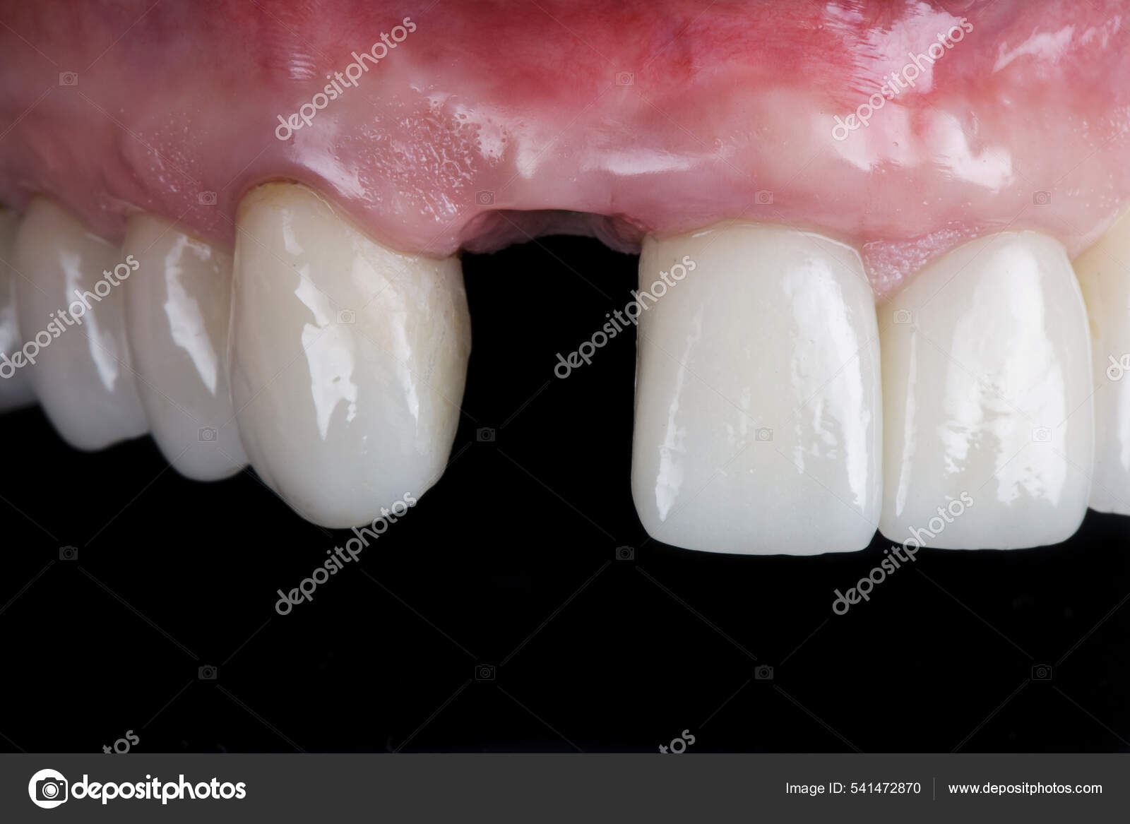 Missing Tooth Maxilla Patient Implantation Placement Crown Stock Photo ...