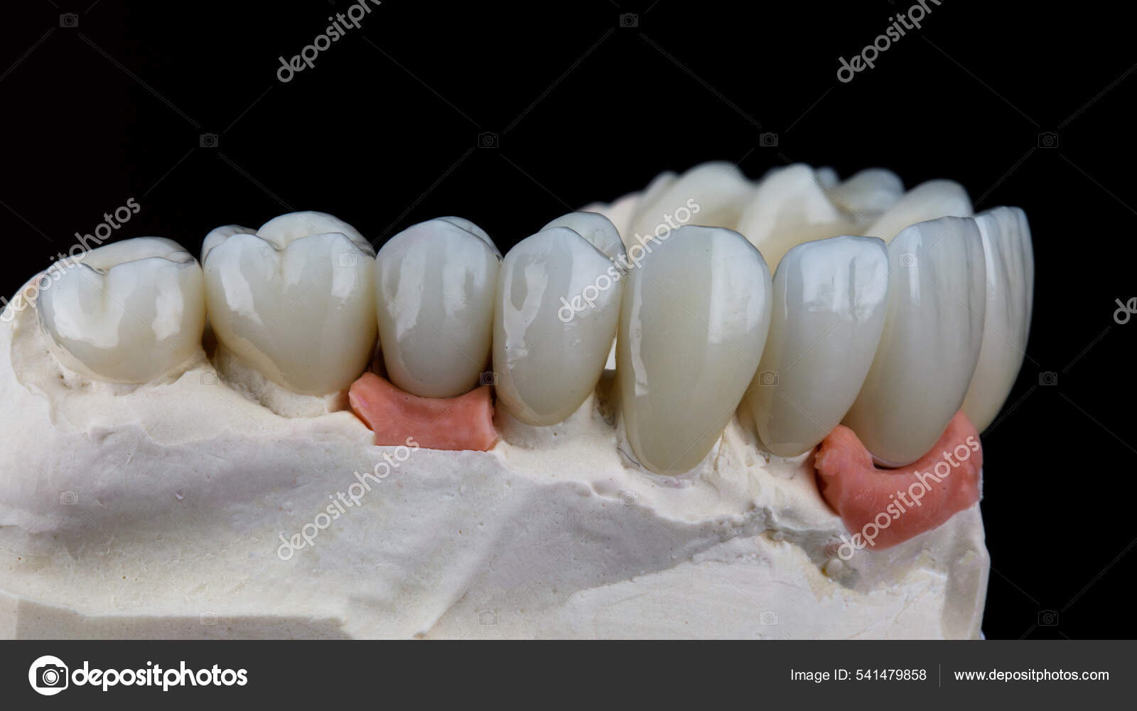 Excellent Composition Dental Veneers Crowns Details Plaster Model Shot ...