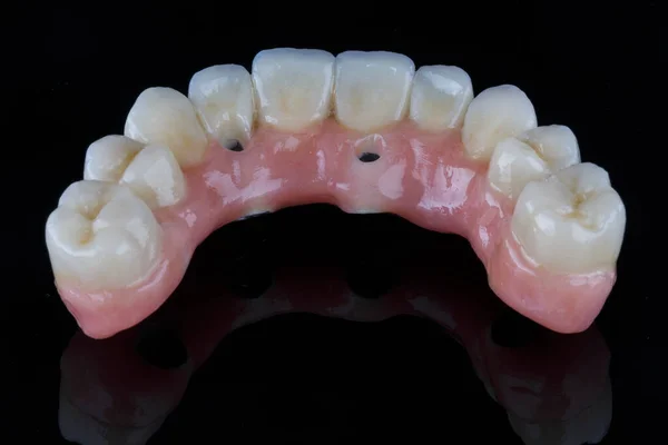 High Quality Denture Upper Jaw Pink Gum Fixation Side Shot — Stock ...