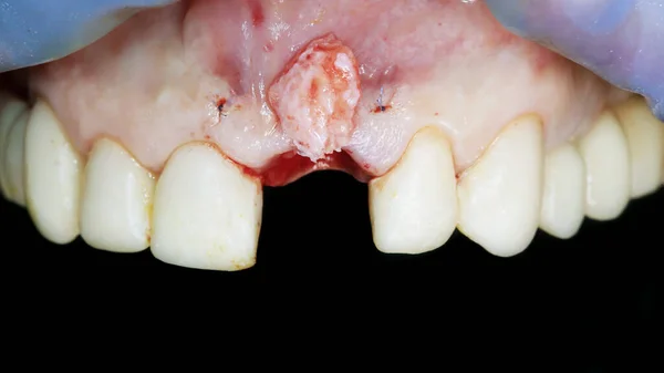 Pericoronite Stock Photos, Royalty Free Pericoronite Images | Depositphotos