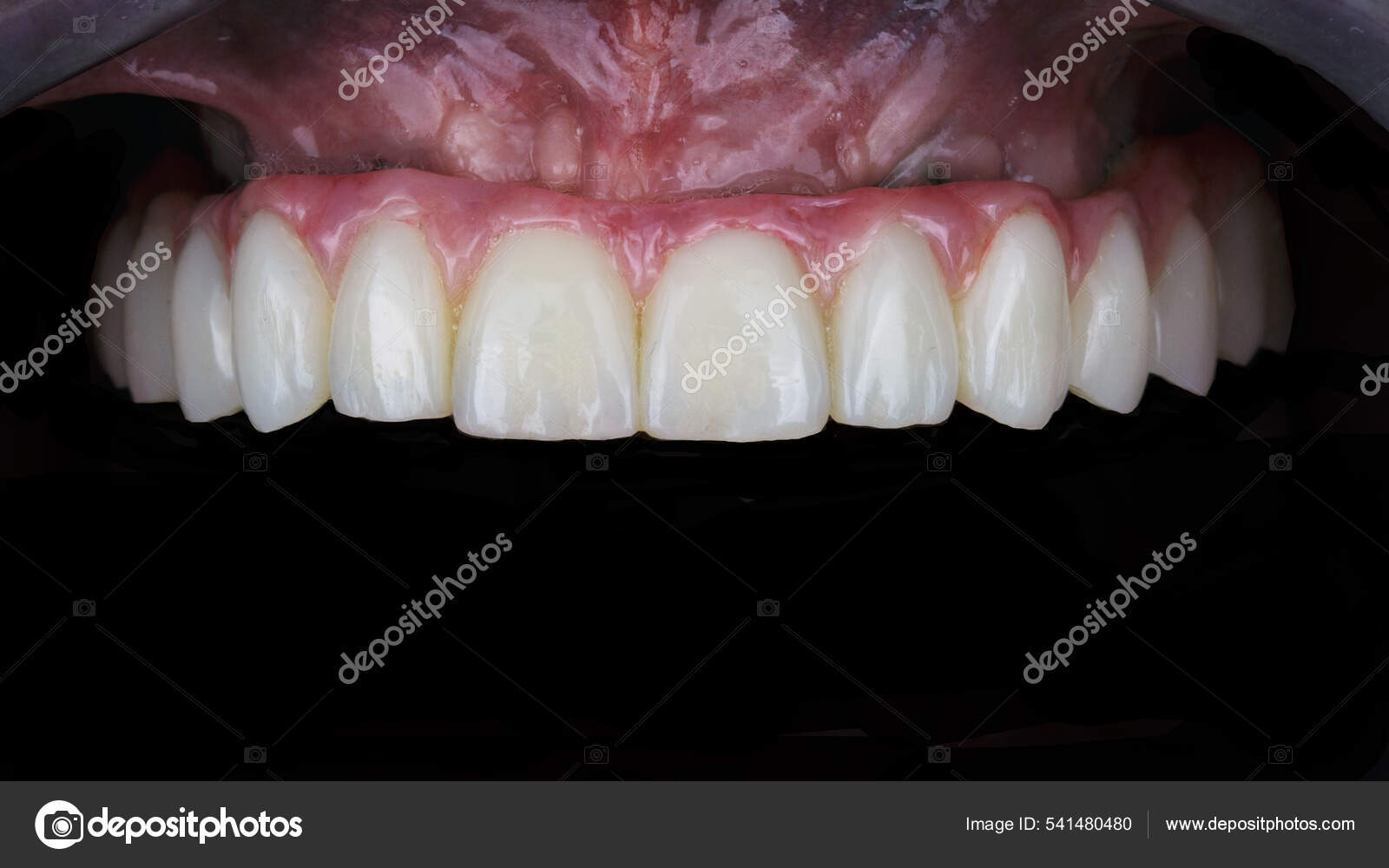 Ceramic Prosthesis Made High Quality Materials Installed Patient's ...