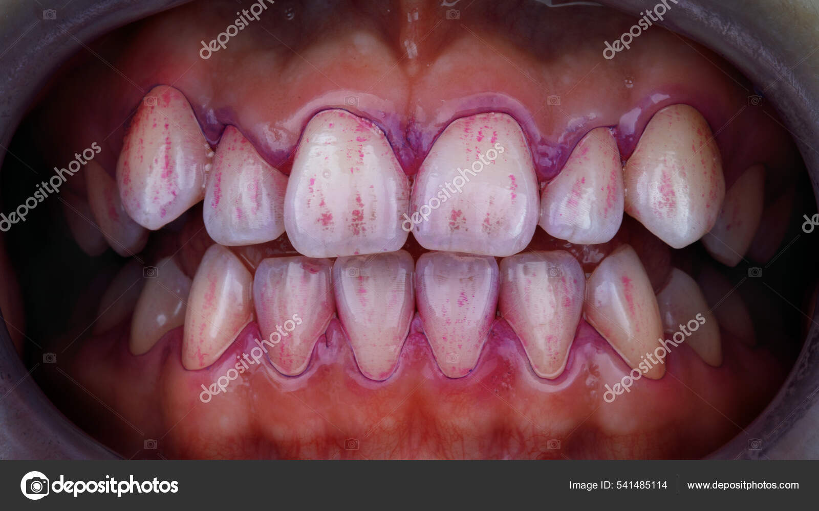 Plaque Indicator Teeth Professional Cleaning Dental Hygienist Stock ...