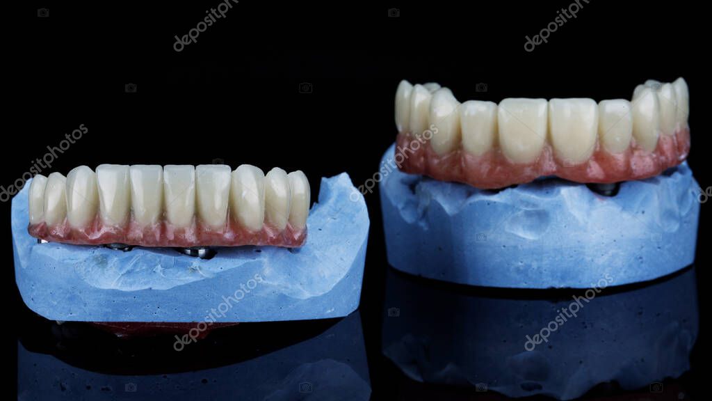prótesis dentales temporales para dos mandíbulas con gingiva artificial ...