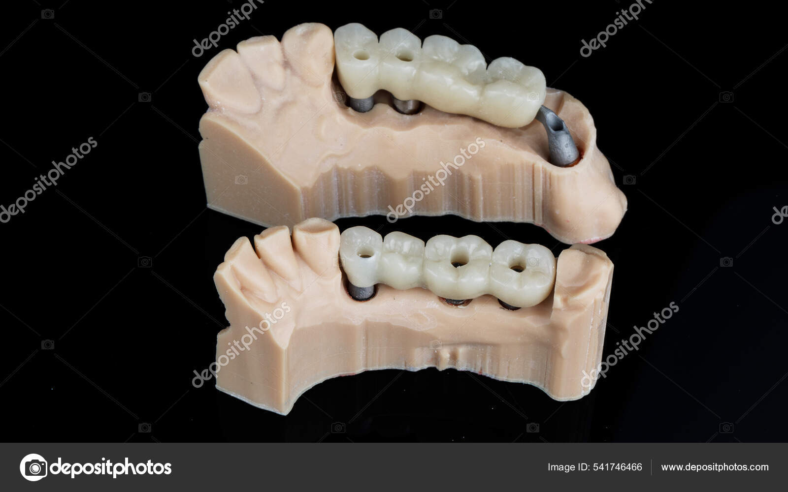Two Dental Bridges Dental Models Temporary Use Shot Black Background ...