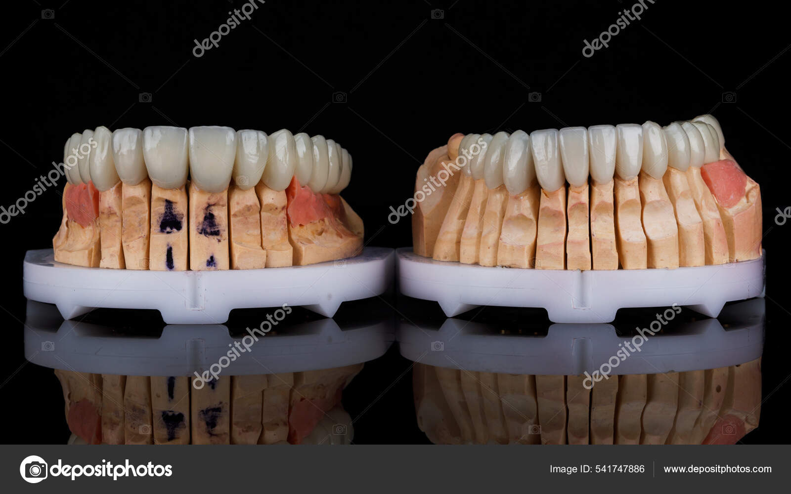 Set High Quality Veneers Upper Lower Jaws Dental Models Made — Stock ...
