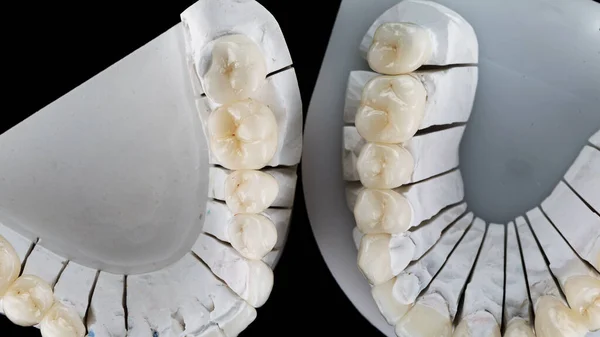 composition of dental crowns made of ceramics on models, view of the ...