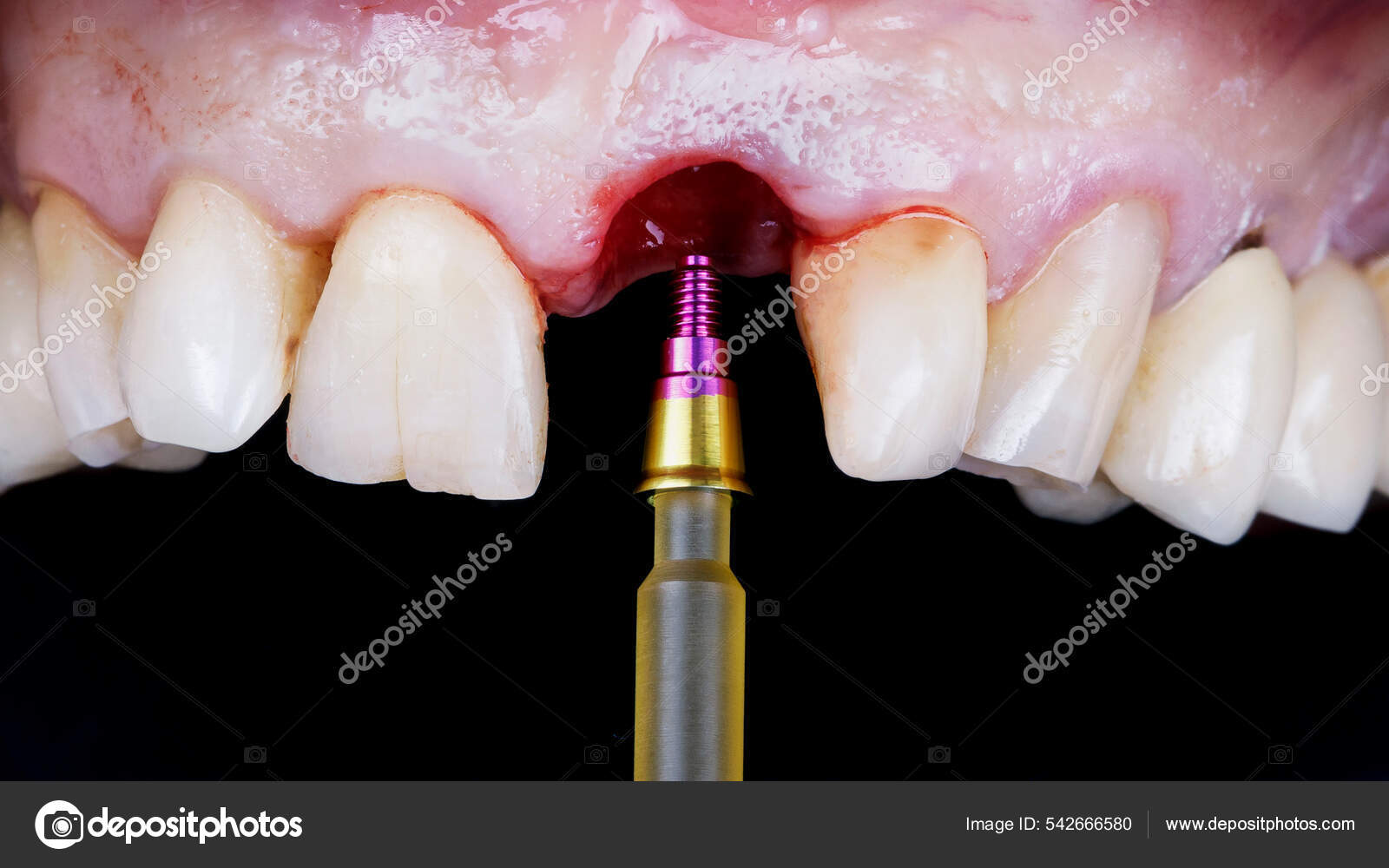 Base Abutment Gum Cavity Implantation Front Tooth Stock Photo by ...