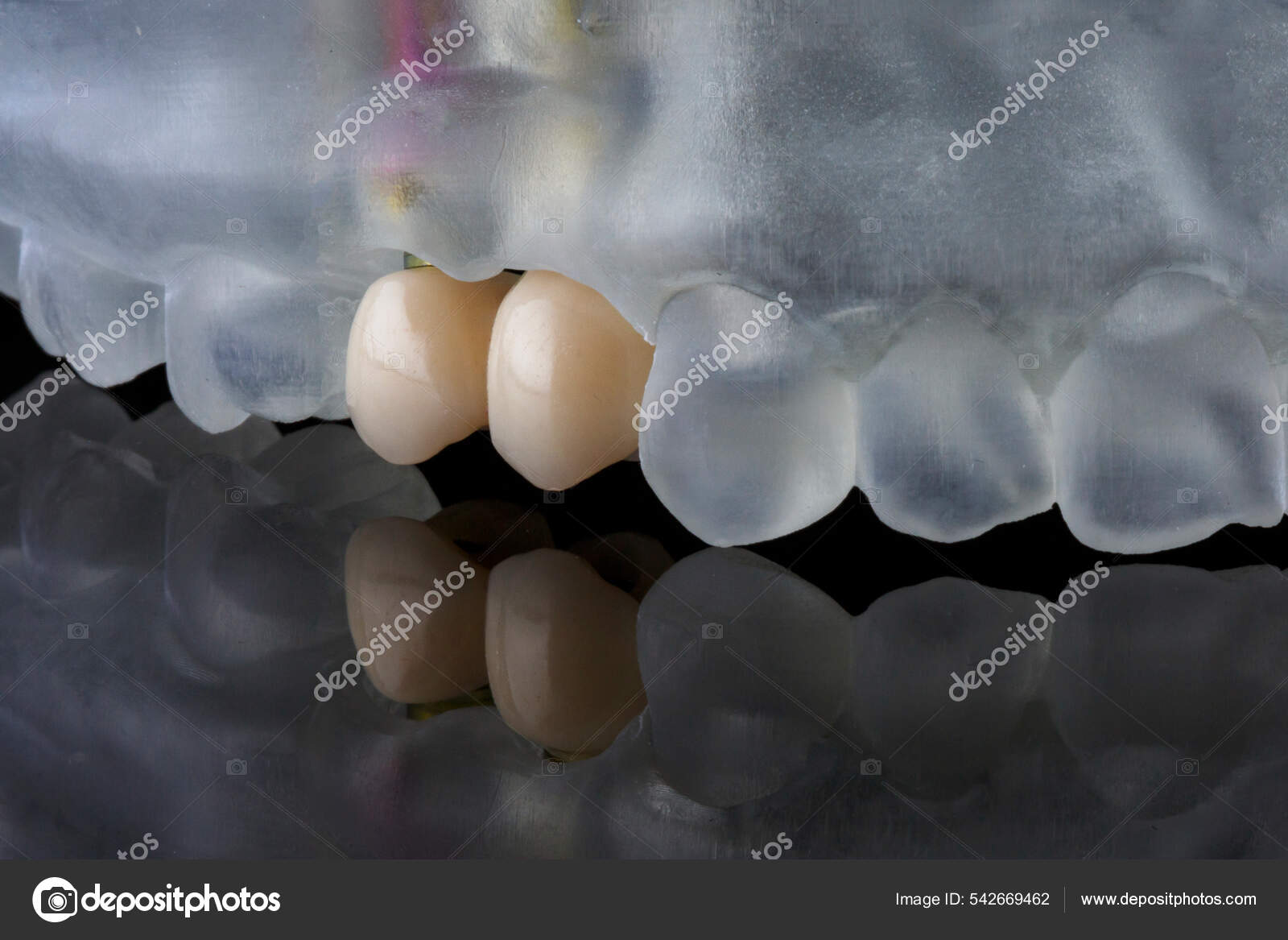 Dental Crowns Shown Special Model Accuracy Stock Photo by ©dendorstock ...
