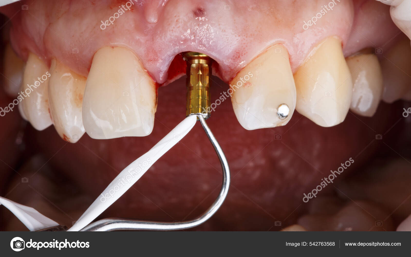 Cinta Dental Para Estribo Antes Unir Corona Temporal — Foto de stock ...