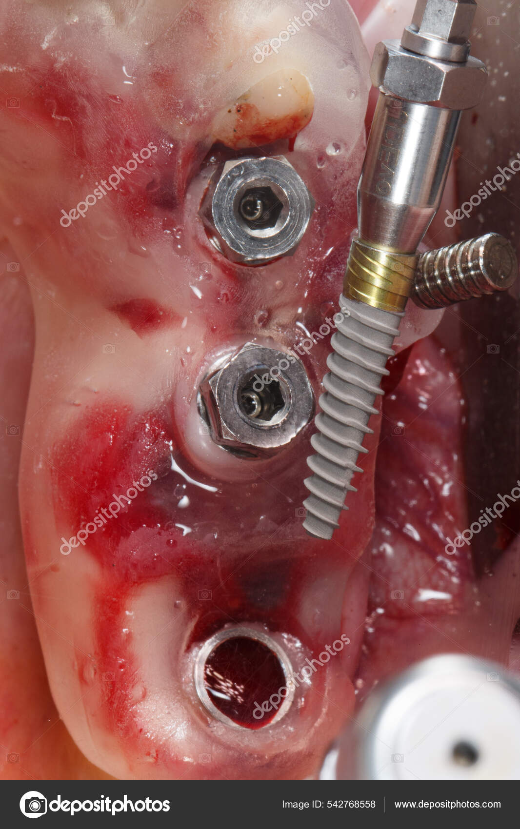 Dental Implantation End Defect Implant Close — Stock Photo ...