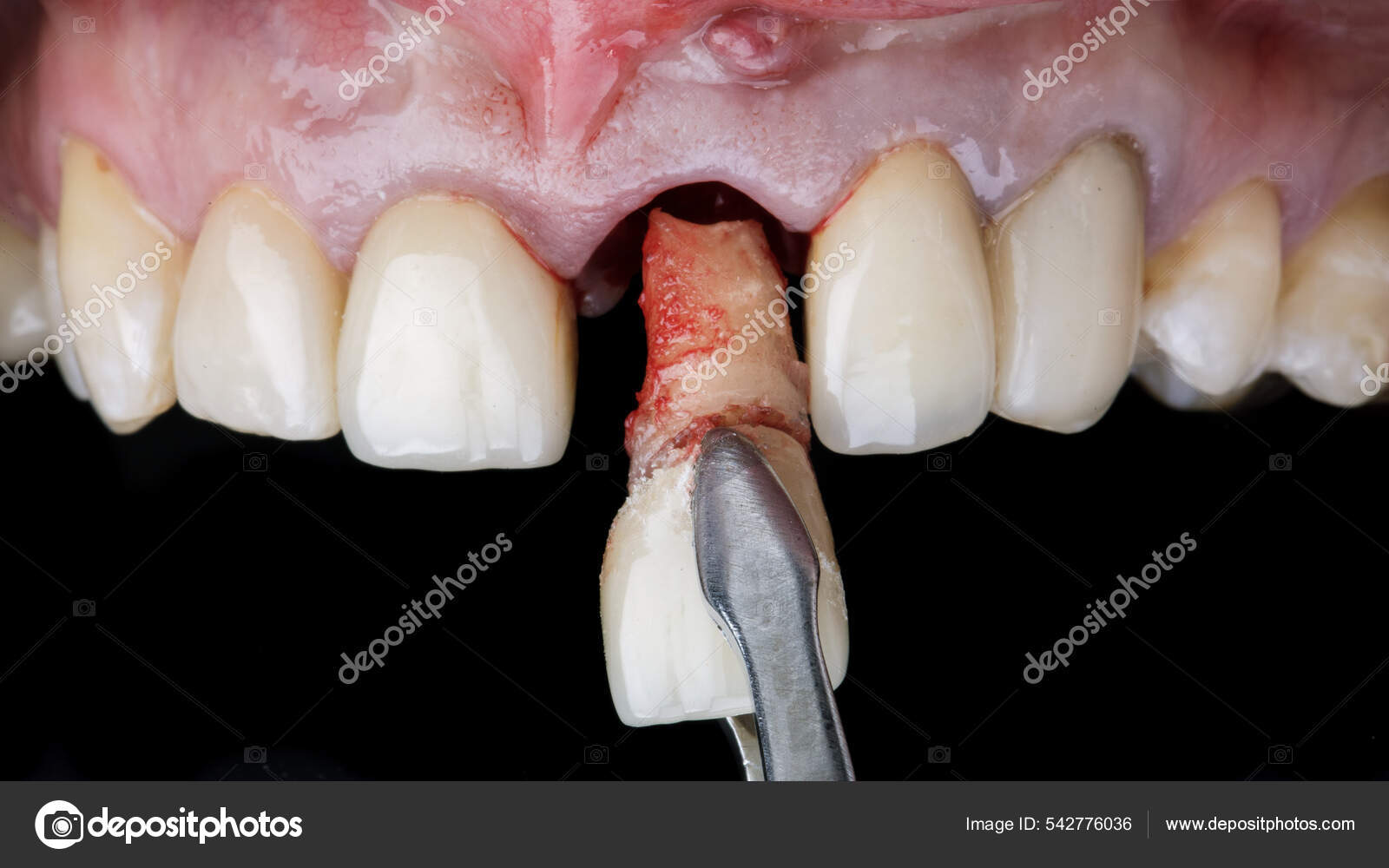 Gum Implantation Lower Jaw Installing Prosthesis Stock Photo by ...