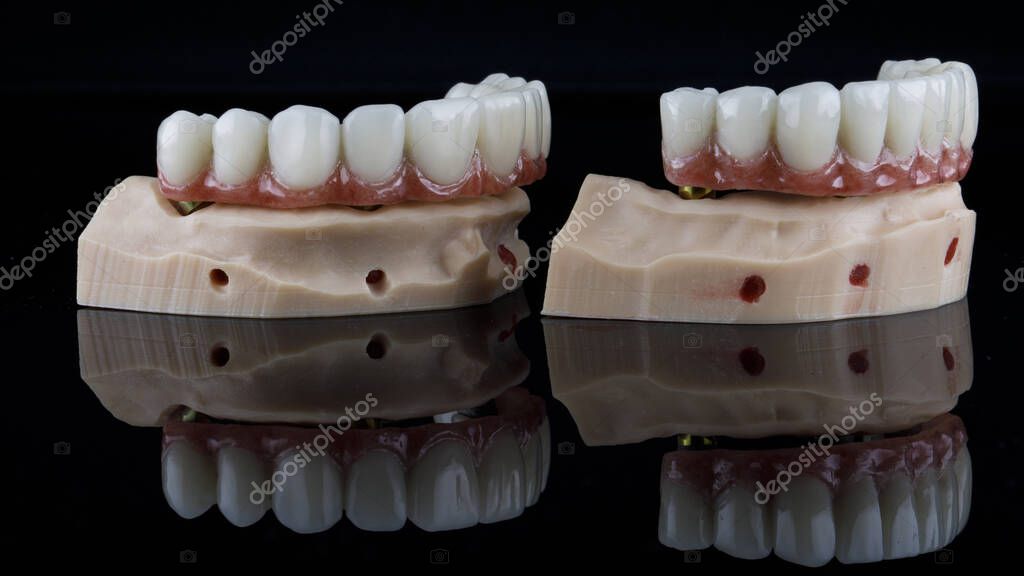 Prótesis de alta calidad para prótesis en modelos de polímero, vista ...