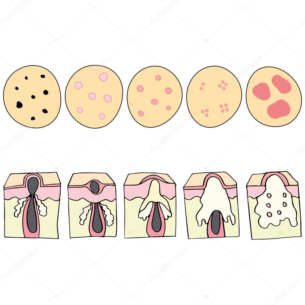 Tipos de acné. Comedones abiertos, comedones cerrados, acné ...