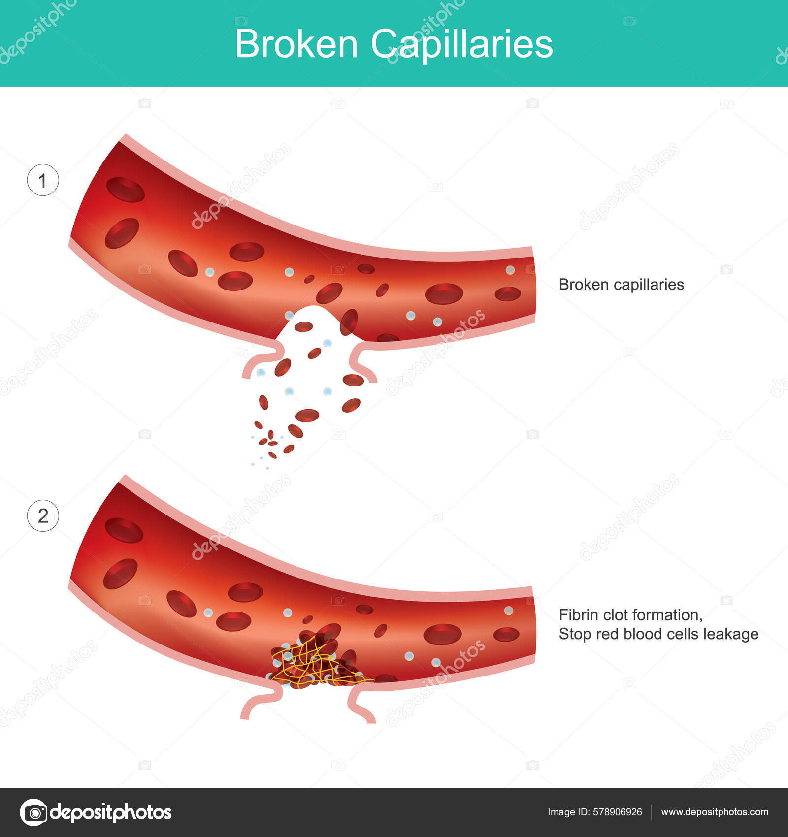 Broken Capillaries Caused Blood Capillaries Expand Too Much Stock ...