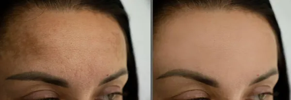 Woman forehead Stock Photos, Royalty Free Woman forehead Images ...