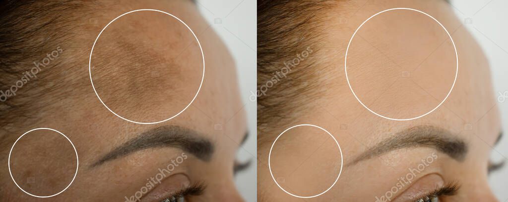 Melasma rosto Stock Photos, Royalty Free Melasma rosto Images ...