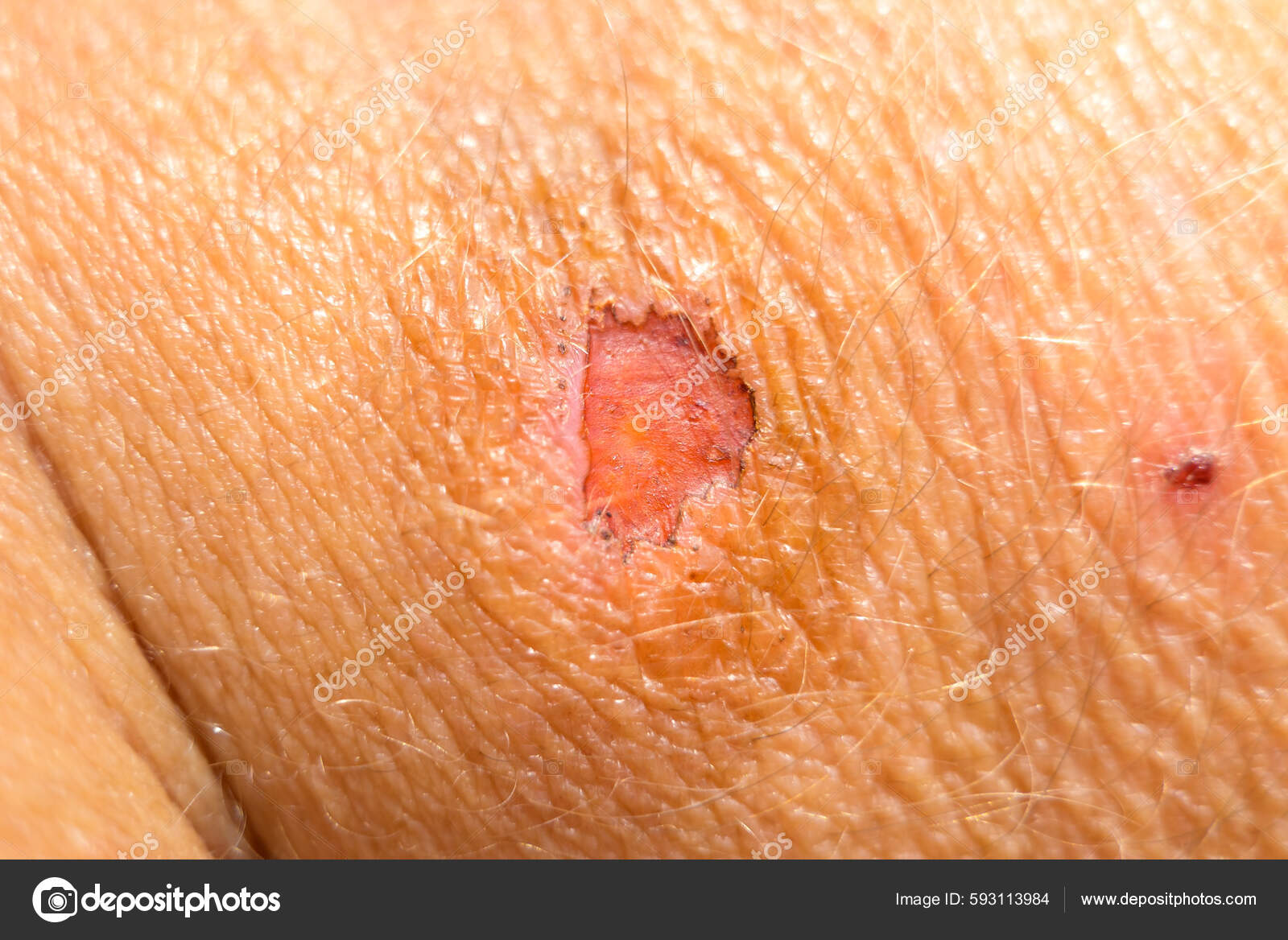 Extreme Close Healing Soft Tissue Wound Surrounding Trauma Persons Arm ...