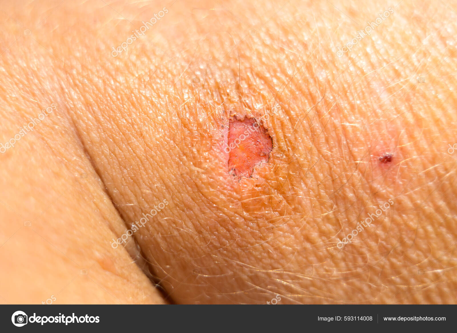 Close Healing Soft Tissue Wound Surrounding Trauma Persons Arm — Stock ...